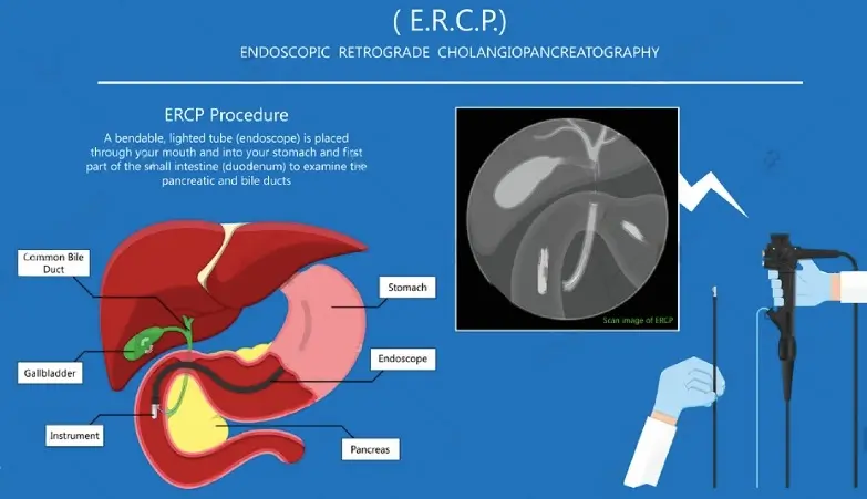 ERCP: Combining Endoscopy and X-Ray to Treat Biliary and Pancreatic Conditions | Bangalore ...